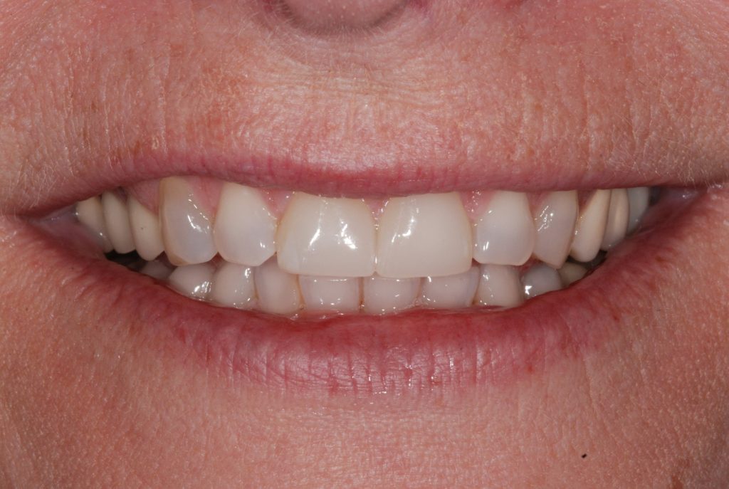 CEREC same day crowns