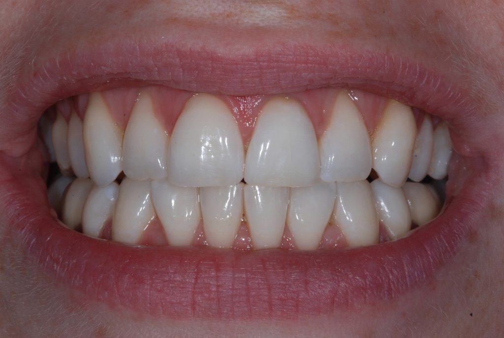 Internal Tooth Bleaching