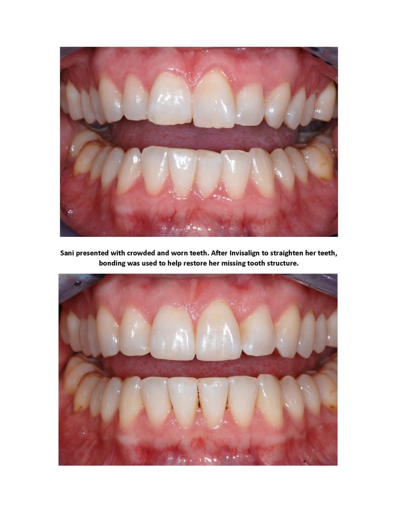 Teeth Before And After Invisalign
